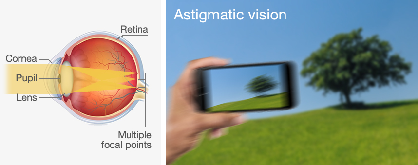 Rutnin-Gimbel LASIK Centre-Pioneer in Laser Eye Surgery