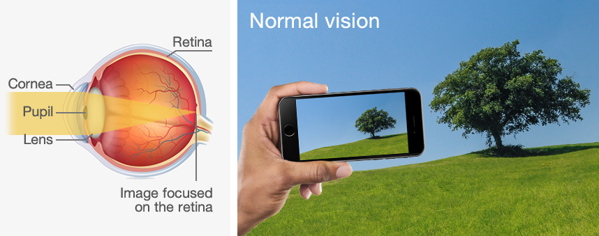 Rutnin-Gimbel LASIK Centre-Pioneer in Laser Eye Surgery