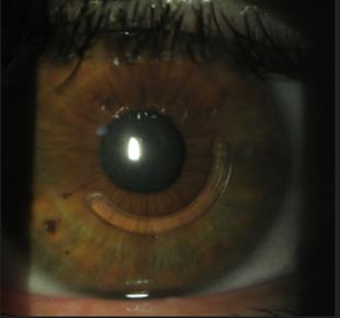 Rutnin-Gimbel LASIK Centre-Pioneer in Laser Eye Surgery