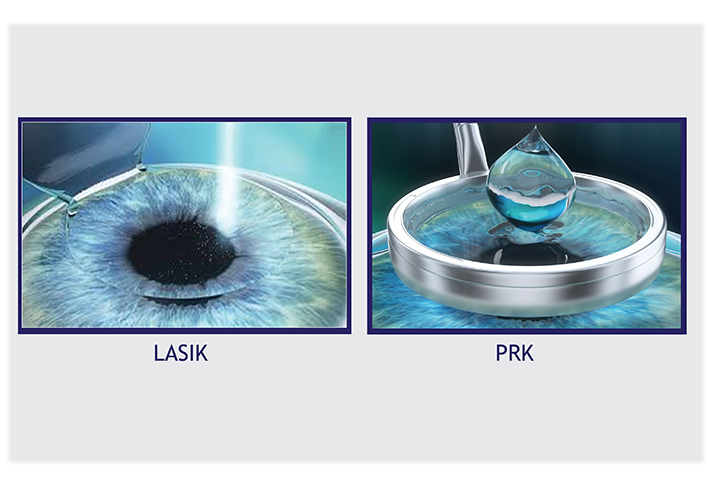 LASIK in General Information